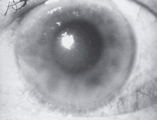 Acute Angle-Closure Glaucoma - Eye Emergencies - Harwood-Nuss' Clinical ...