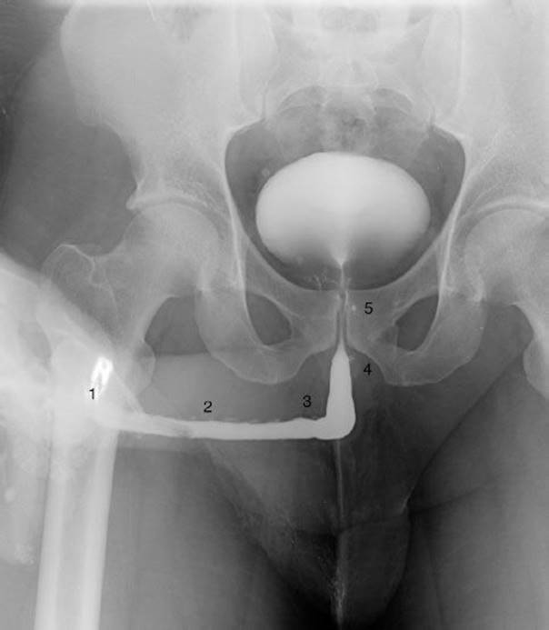 Genitourinary Stents and Catheters - Renal and Urologic Emergencies ...