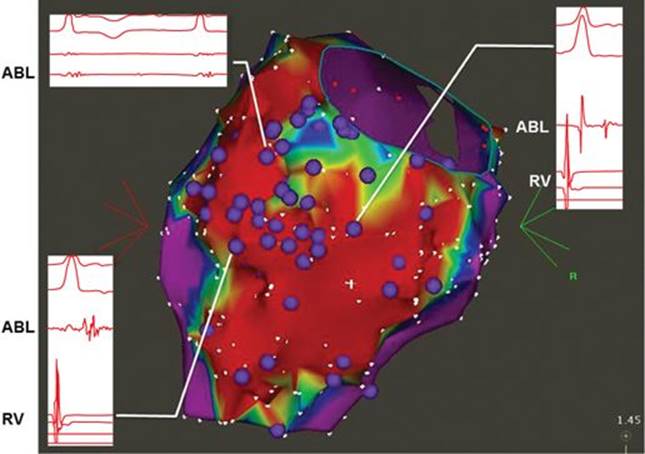 ABLATION OF VENTRICULAR TACHYCARDIA USING CARTO 3-DIMENSIONAL ...
