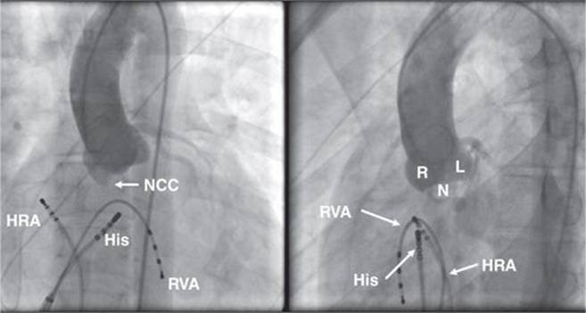 ATRIOVENTRICULAR RECIPROCATING TACHYCARDIA: RIGHT-SIDED - Color Atlas ...