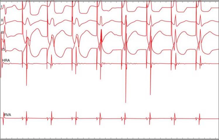 ANALYSIS OF CHALLENGING INTRACARDIAC ELECTROGRAMS: CASE I—ORTHODROMIC ...