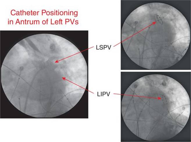 TECHNOLOGIES FOR ABLATION OF ATRIAL FIBRILLATION: DUTY-CYCLE ABLATION ...