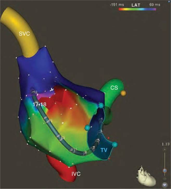 INCISIONAL ATRIAL FLUTTER: INSIGHTS ON HOW TO MAP AND ABLATE NON ...