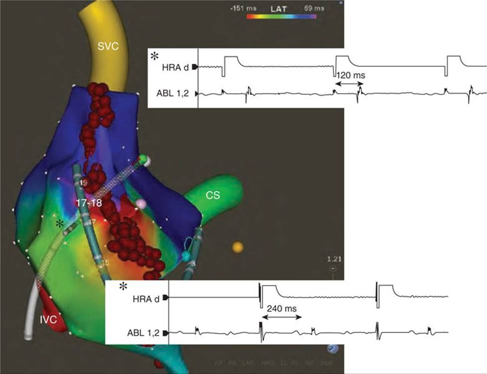 INCISIONAL ATRIAL FLUTTER: INSIGHTS ON HOW TO MAP AND ABLATE NON ...