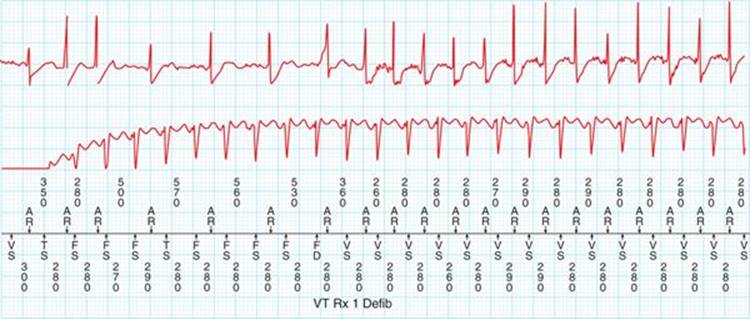 DEVICE TROUBLESHOOTING: CASE I—DIAGNOSIS OF SVT VERSUS VT - Color Atlas ...