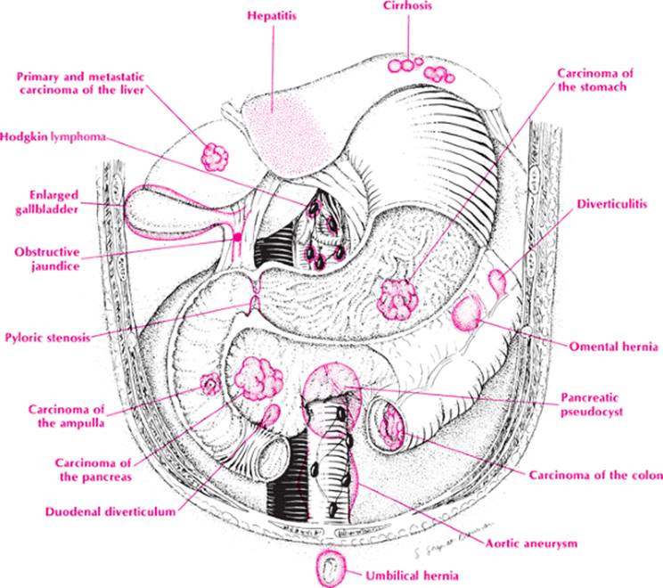 Abdominal Mass - Differential Diagnosis in Primary Care, 4th Edition