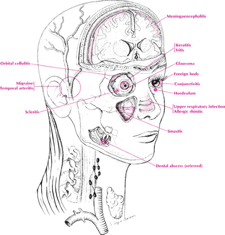 Eye Pain - Differential Diagnosis in Primary Care, 4th Edition