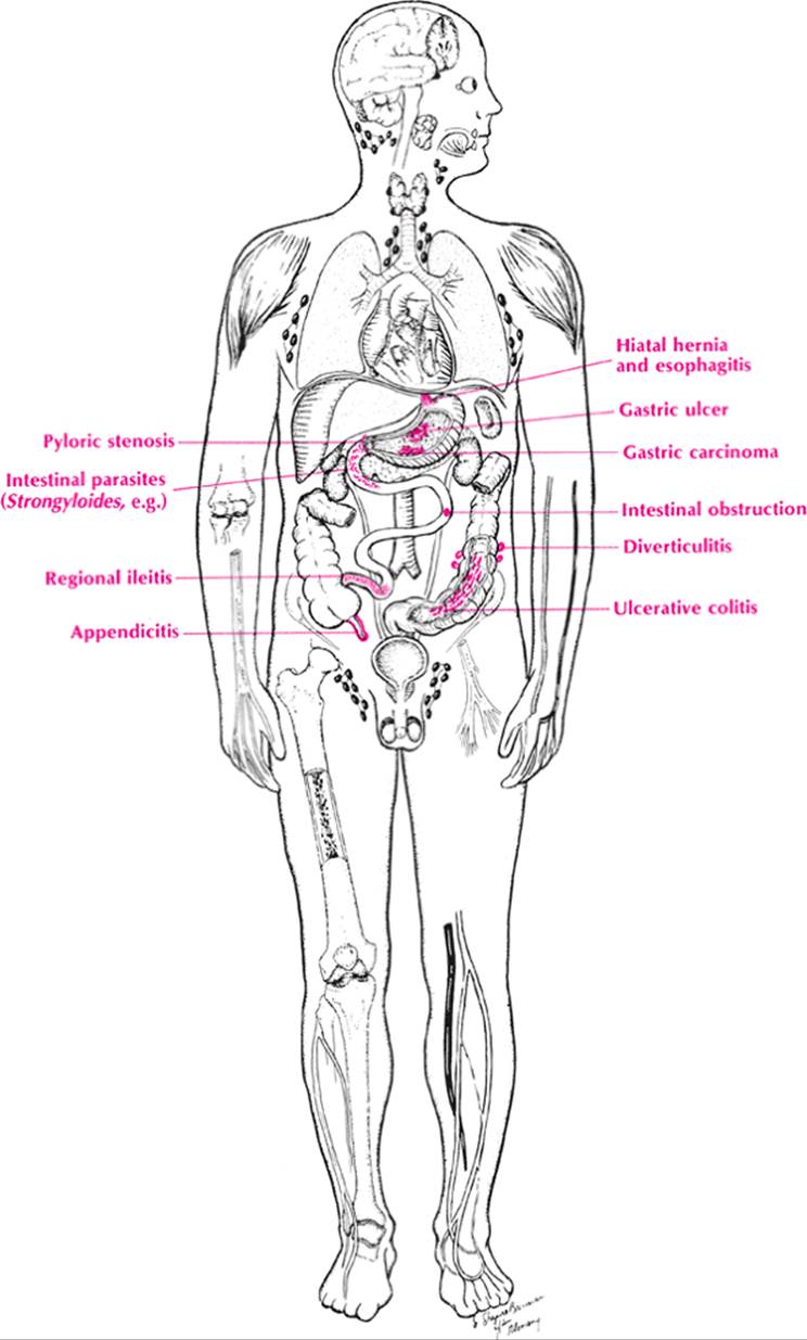 Nausea and Vomiting - Differential Diagnosis in Primary Care, 4th Edition