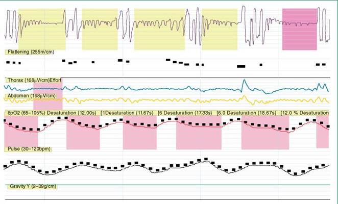 Sleep-related disorders - Essential respiratory medicine