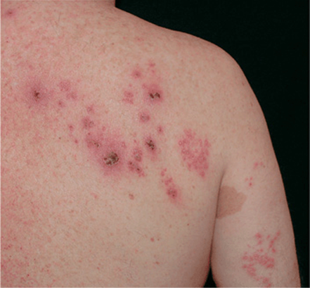 Viral Diseases Of Skin And Mucosa Fitzpatrick39s Color