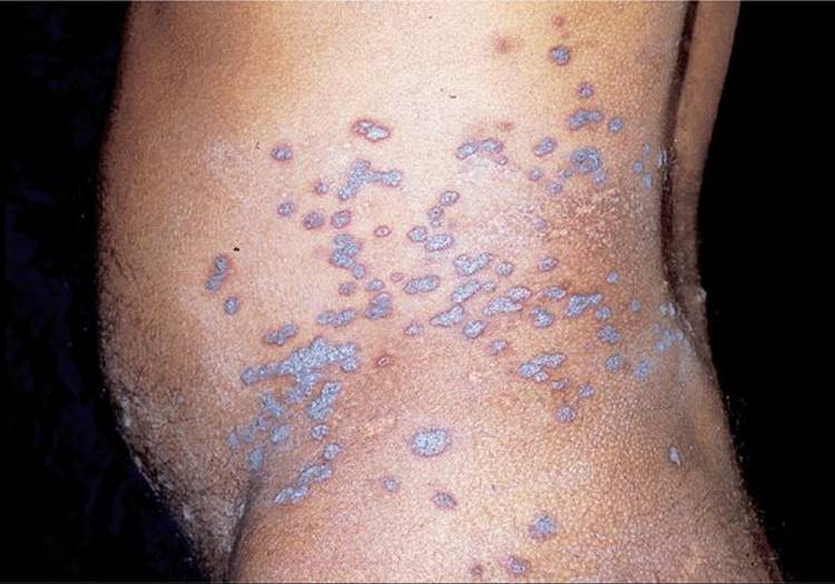 Viral Diseases of Skin and Mucosa - Fitzpatrick's Color Atlas and ...