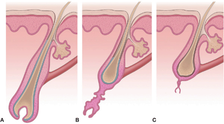 Disorders of Hair Follicles and Related Disorders - Fitzpatrick's Color ...