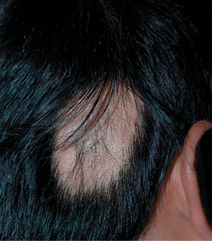 Disorders of Hair Follicles and Related Disorders - Fitzpatrick's Color ...