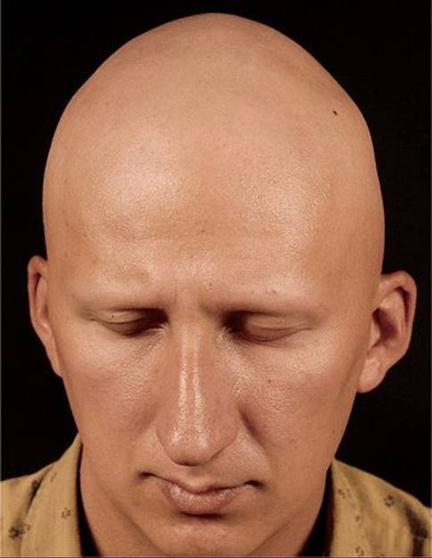 Disorders of Hair Follicles and Related Disorders - Fitzpatrick's Color ...