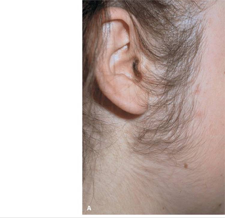 Disorders of Hair Follicles and Related Disorders - Fitzpatrick's Color ...