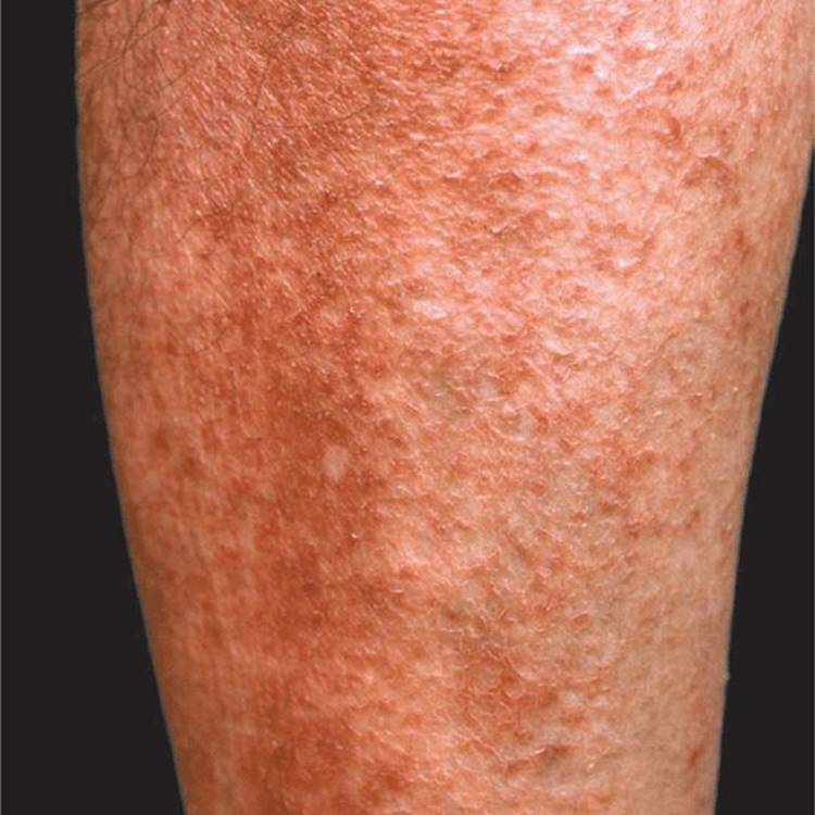 Eczema/Dermatitis - Fitzpatrick's Color Atlas and Synopsis of Clinical ...
