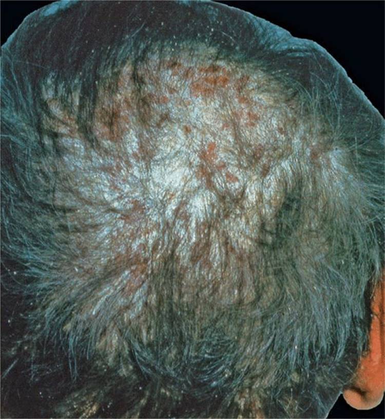 Psoriasis and Psoriasiform Dermatoses - Fitzpatrick's Color Atlas and ...