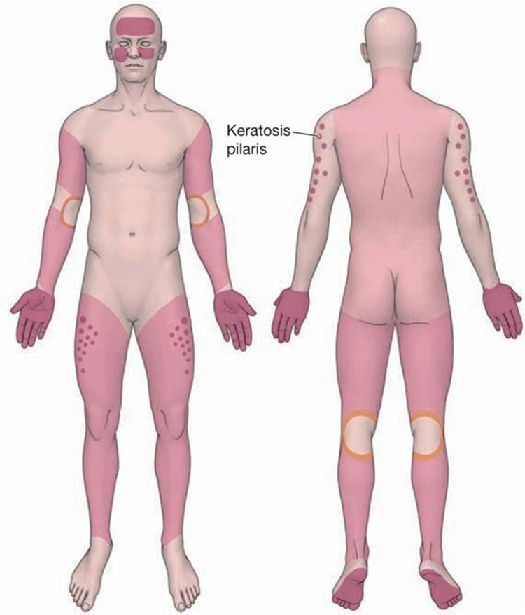 Ichthyoses - Fitzpatrick's Color Atlas and Synopsis of Clinical ...