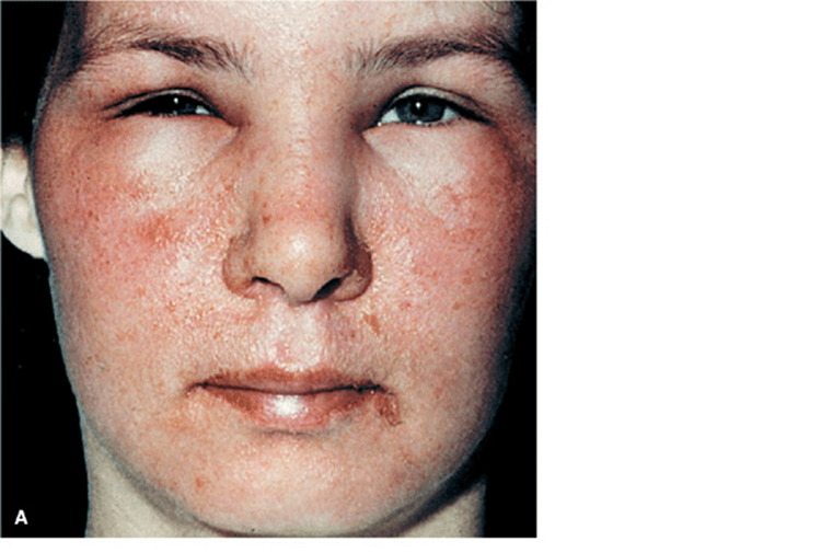 Photosensitivity, Photo-Induced Disorders, and Disorders by Ionizing ...