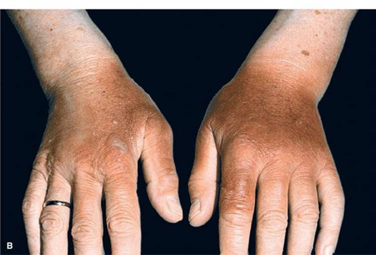 Photosensitivity, Photo-Induced Disorders, and Disorders by Ionizing ...