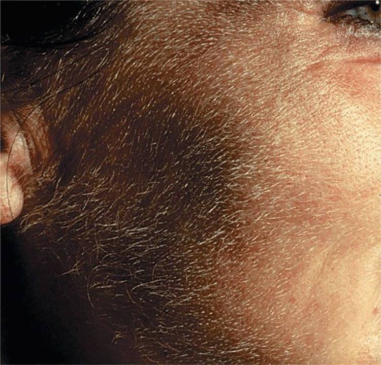 Photosensitivity, Photo-Induced Disorders, and Disorders by Ionizing ...