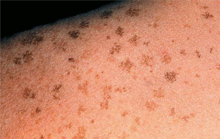 Photosensitivity, Photo-Induced Disorders, and Disorders by Ionizing ...