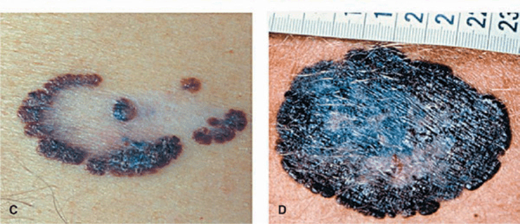 Melanoma Precursors and Primary Cutaneous Melanoma - Fitzpatrick's ...