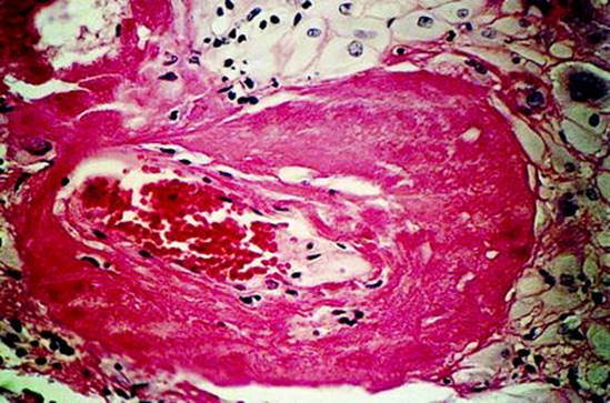 Hughes Syndrome: Pregnancy and Fertility - Hughes Syndrome: The ...