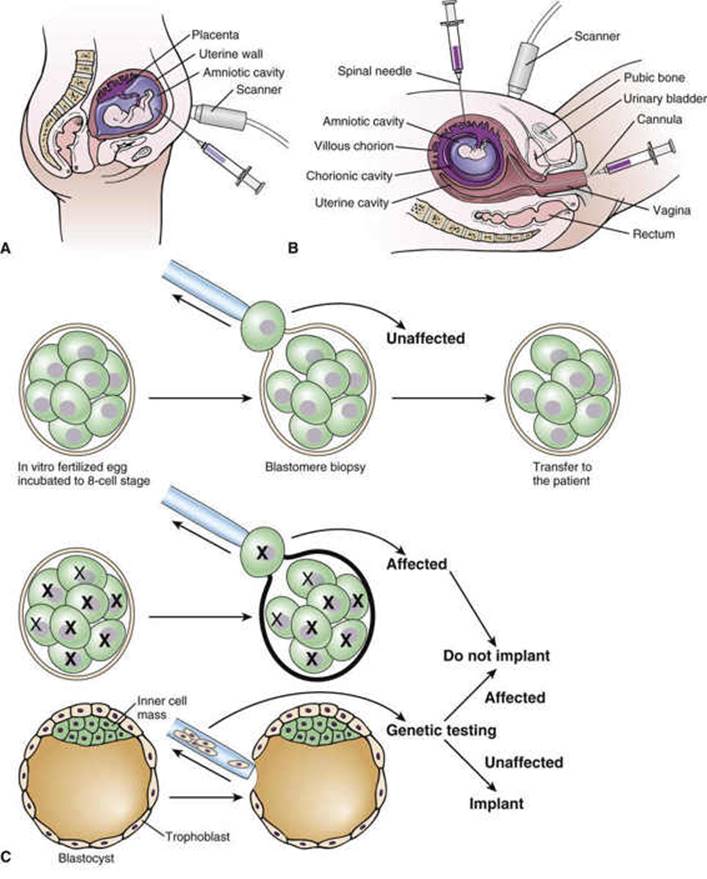 Prenatal Diagnosis and Screening - Thompson & Thompson Genetics in ...
