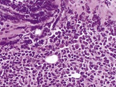 Mediastinal T-Lymphoblastic Lymphoma (T-LBL) - Thoracic Pathology: A ...