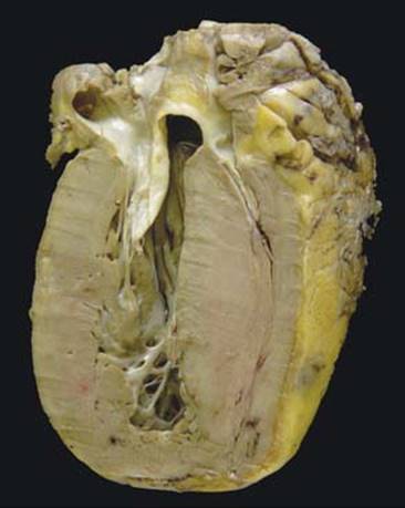 Hypertrophic Cardiomyopathy - Thoracic Pathology: A Volume in the High ...