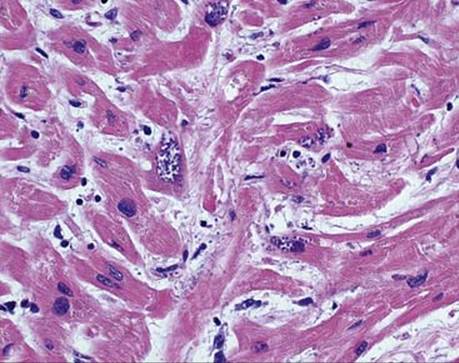 Opportunistic Cardiac Infections - Thoracic Pathology: A Volume in the ...