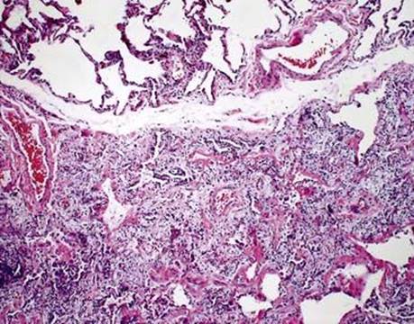 Acute Interstitial Pneumonia (AIP) - Thoracic Pathology: A Volume in ...