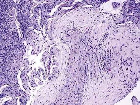 Cryptogenic Organizing Pneumonia (COP) - Thoracic Pathology: A Volume ...
