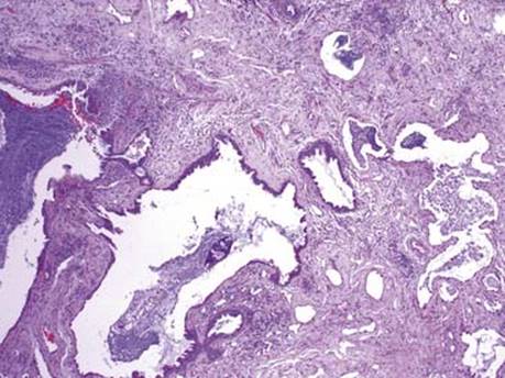 Rheumatoid Arthritis (RA) - Thoracic Pathology: A Volume in the High ...