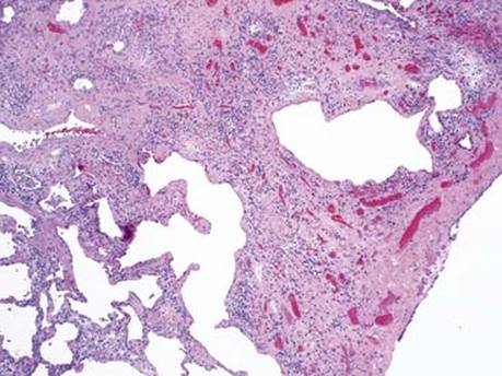 Polymyositis and Dermatomyositis–Associated Lung Disease - Thoracic ...