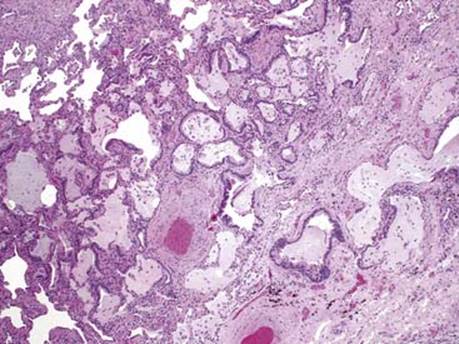 Polymyositis and Dermatomyositis–Associated Lung Disease - Thoracic ...