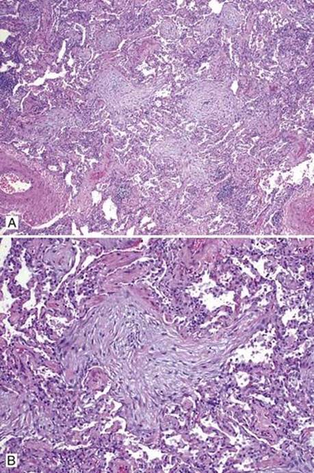 Polymyositis and Dermatomyositis–Associated Lung Disease - Thoracic ...