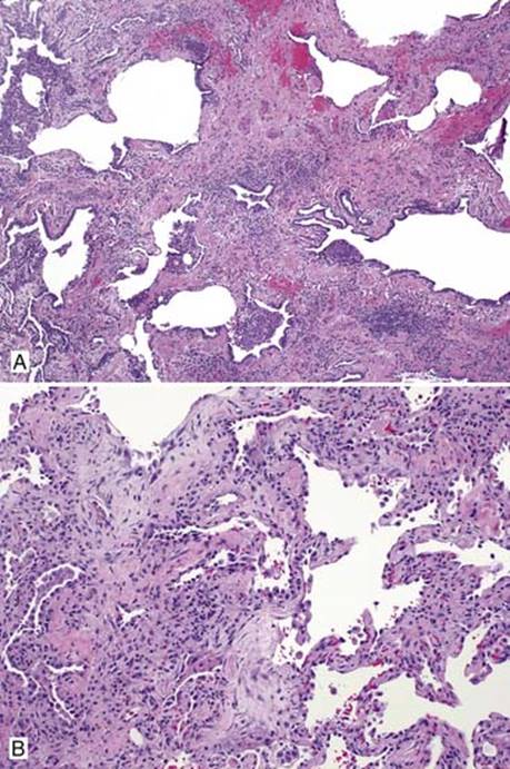 Polymyositis and Dermatomyositis–Associated Lung Disease - Thoracic ...