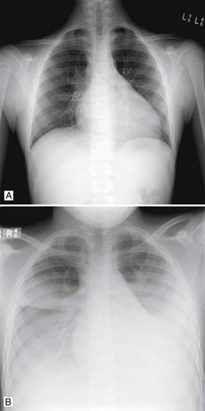 Acute Chest Syndrome (ACS) of Sickle Cell Disease - Thoracic Pathology ...