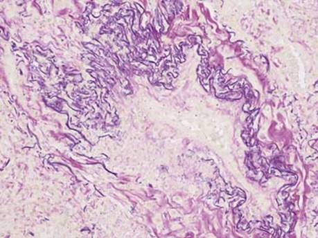 Pulmonary Wegener Granulomatosis - Thoracic Pathology: A Volume in the ...