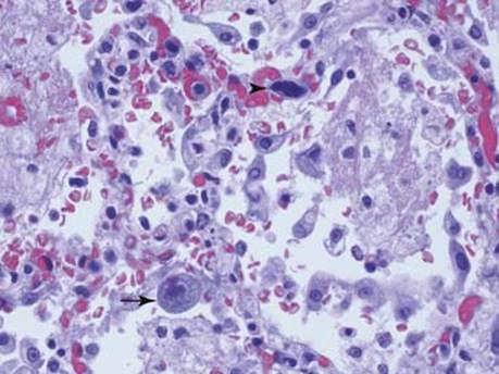 Cytomegalovirus (CMV) Pneumonia - Thoracic Pathology: A Volume in the ...