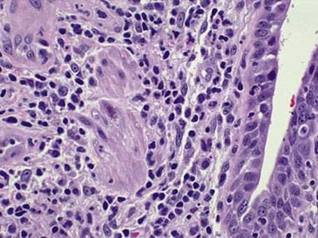 Cytomegalovirus (CMV) Pneumonia - Thoracic Pathology: A Volume in the ...