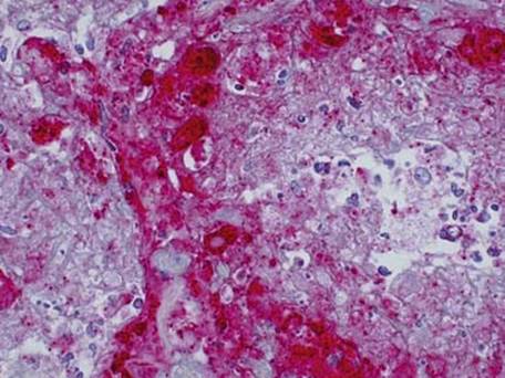 Herpes Simplex Virus (HSV) Pneumonia - Thoracic Pathology: A Volume in ...