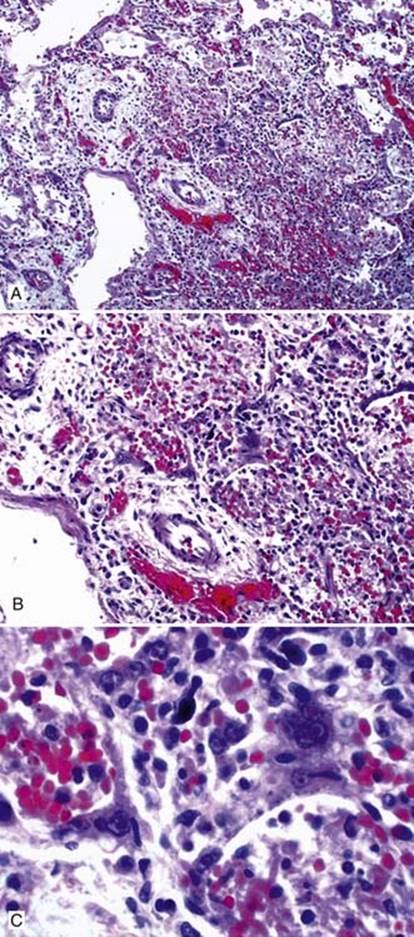 Measles Pneumonia - Thoracic Pathology: A Volume in the High Yield ...