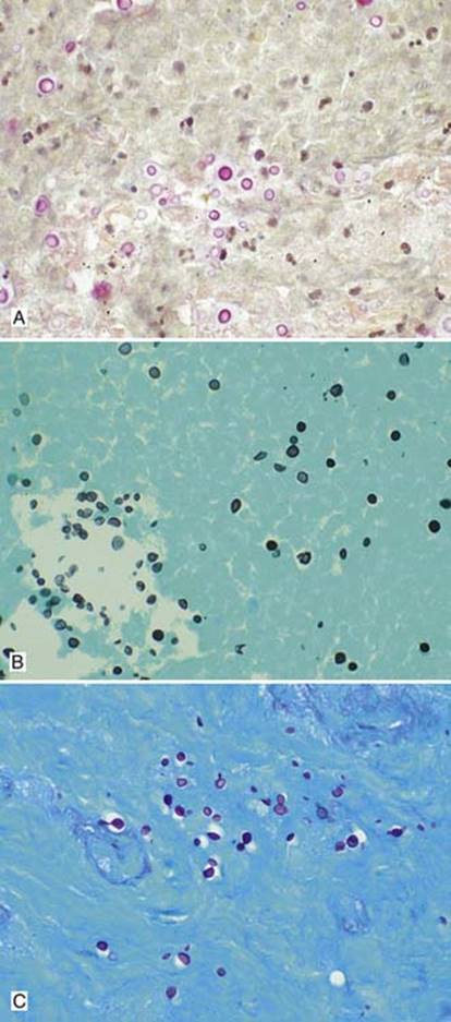 Cryptococcosis - Thoracic Pathology: A Volume in the High Yield ...