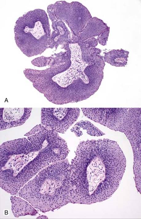 Squamous Papillomatosis - Thoracic Pathology: A Volume in the High ...