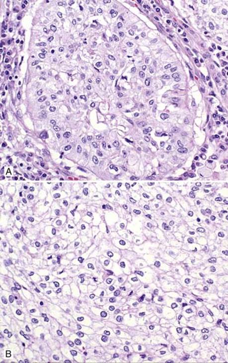 Clear Cell Variant of Squamous Cell Carcinoma (SCC) - Thoracic ...