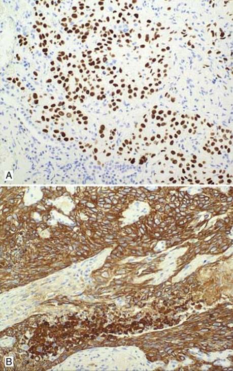 Clear Cell Variant of Squamous Cell Carcinoma (SCC) - Thoracic ...