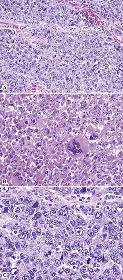 Large-Cell Carcinoma - Thoracic Pathology: A Volume in the High Yield ...